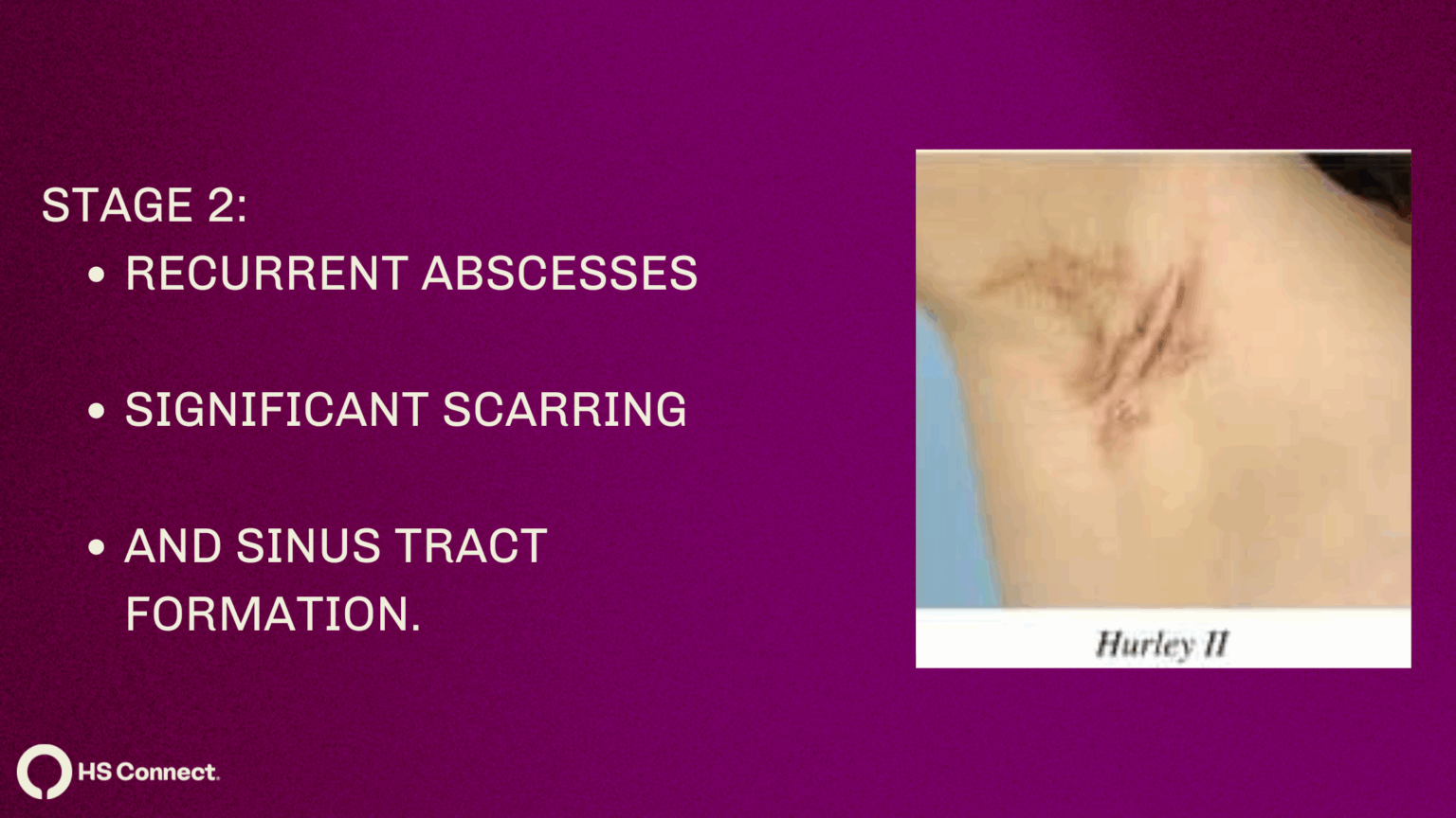 What are the Stages of Hidradenitis Suppurativa? And Who the Heck is ...